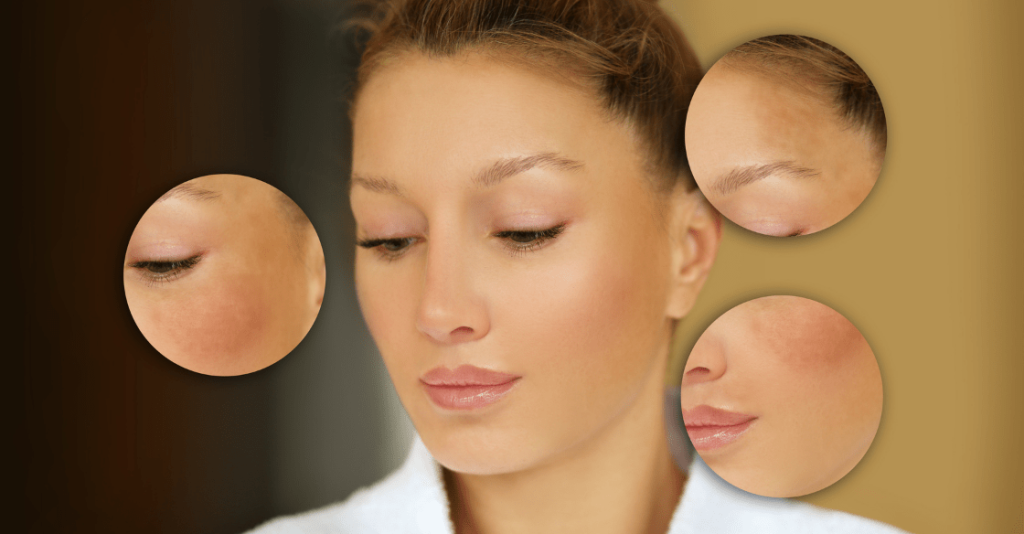 The Best Facials for Scars & Hyperpigmentation | SDBotox