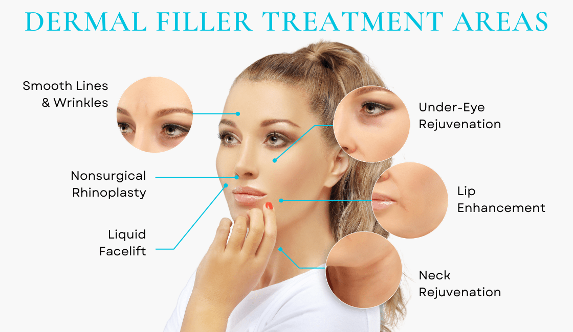 Dermal Fillers in San Diego - SD Botox